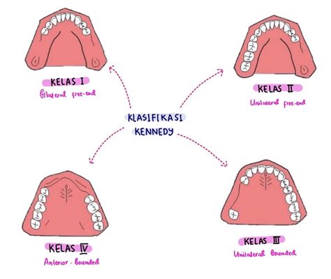 Klasifikasi Kennedy Info Drg