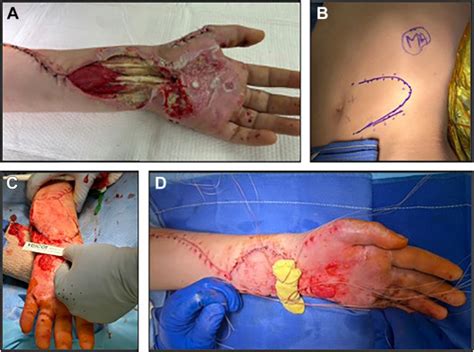 Military Ballistic Injuries Of The Upper Extremity Hand Clinics