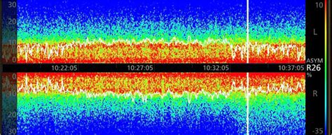 Spectrogram Of Sevoflurane Based Anesthesia With Highest Power In The