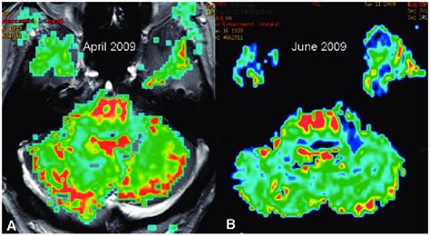 Early Perfusion Weighted Imaging Follow Up A Initial Download Scientific Diagram