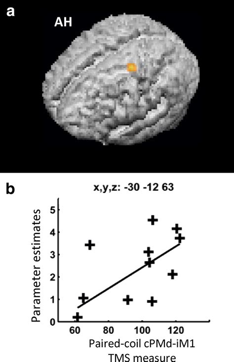 The Role Of Contralesional Dorsal Premotor Cortex After Stroke As