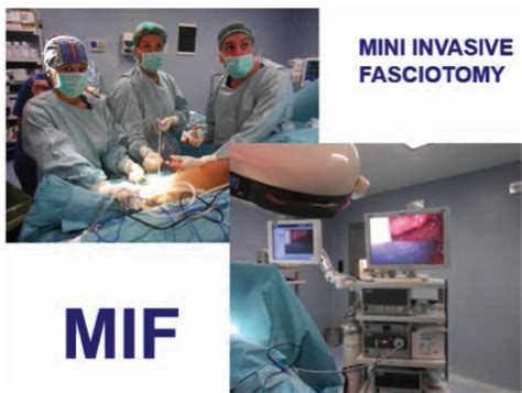 Mini Invasive Fasciotomy Is Performed By Endoscopic Technique The Skin Download Scientific