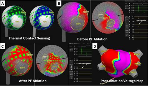 Af Ablation Using A Novel Single Shot” Map And Ablate Spherical Array Pulsed Field Ablation