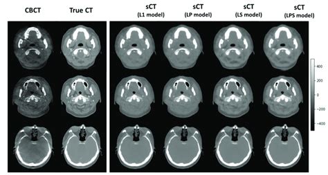 Examples Of Dl Output Images True Ct Cbct Synthetic Ct L1 Loss Download Scientific Diagram