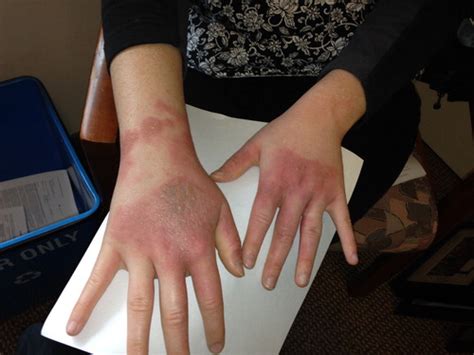 Full Article Lime Induced Phytophotodermatitis