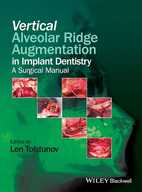 Buy Vertical Alveolar Ridge Augmentation In Implant Dentistry A