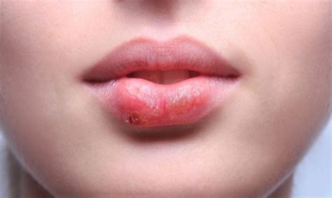 Queilitis Angular Causas Y Tratamiento De Las Boqueras