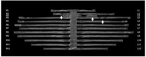 unfolded rib view of an 83 year old female patient with reconstruction