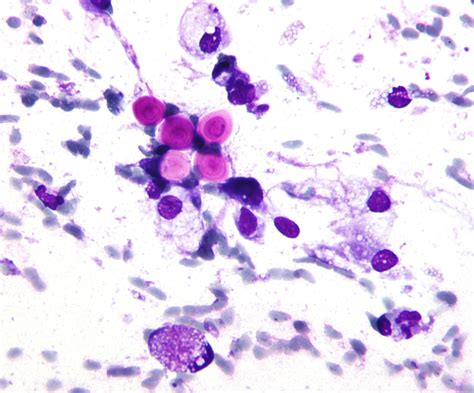 Cryptococcal Meningitis A Hiv Aids Associated Infection — Youth Stem 2030