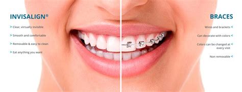 Overbite What Is It And Why Correcting An Overbite Is Important