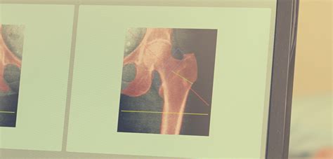 Bone Densitometry