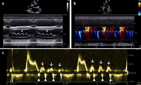 Atrial Flutter With 51 Conduction Notice The Fluttering Of The