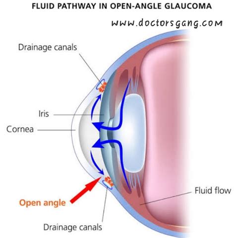 Primary Open Angle Glaucoma Signs And Symptoms Primary Open Angle Glaucoma Causes Symptoms