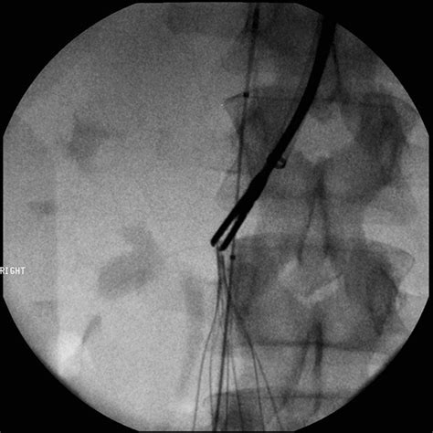 Ivc Filter Replacementremoval Northwest Radiology