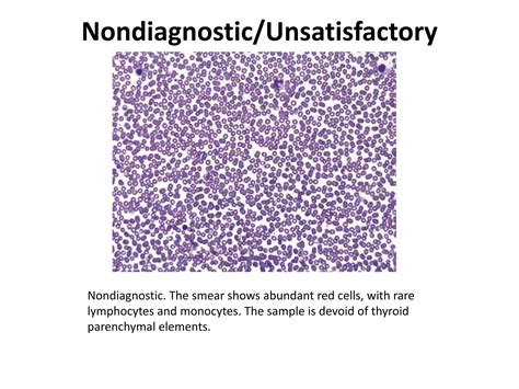 The Bethesda System For Reporting Thyroid Cytopathology Pptx