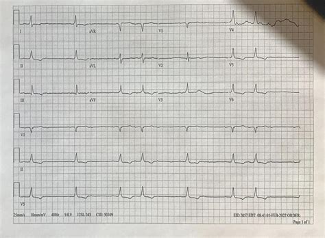 70yr Old Male With 1 Episode Of Syncope Kco Afib On Metoprolol And Apixaban Rekgs