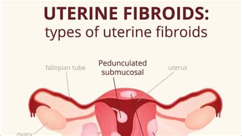 Fibroid Benign Conditions Of Myometrim Gynaecology Gynae