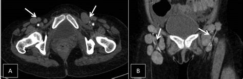 A 25 Year Old Female Patients Kco Small Bowel Ileocolic Junction B Download Scientific