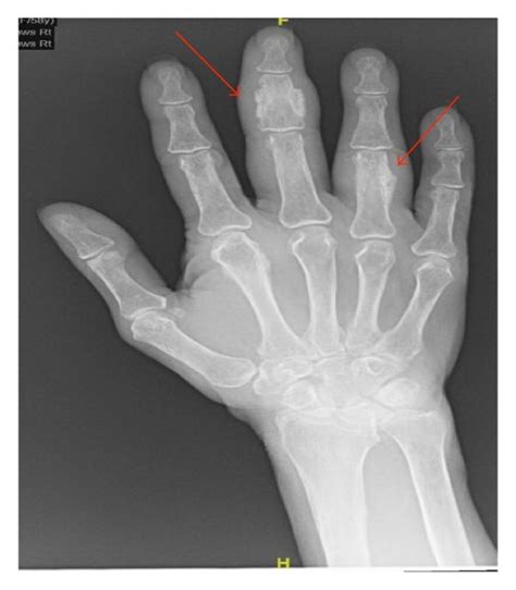 Examination Findings And Radiograph Illustrating Periostitis Of The