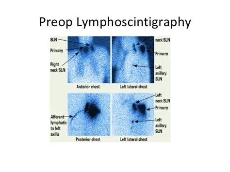 Melanoma