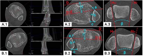 Distal Tib Fib Joint