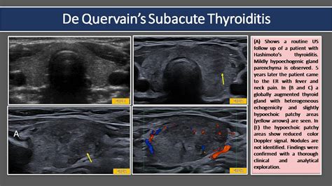 Subacute Thyroiditis Ultrasound