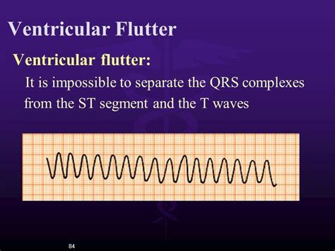Ventricular Flutter