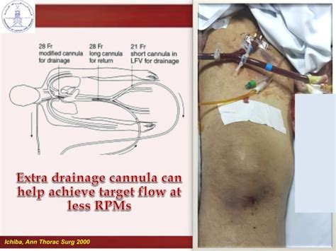 Cannulation And Recirculation In Vv Ecmo