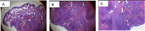 A B And C Histopathology Examination Showed Proliferation Of Download Scientific Diagram