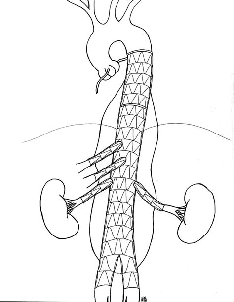 Dissection Vs Rupture At Madalyn Hartley Blog