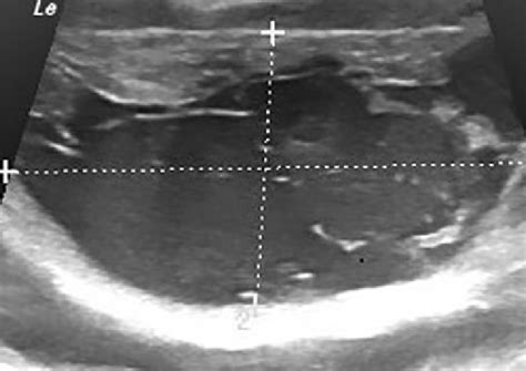 Brain Ultrasonography Shows Large Sgh Measuring 51x26x37 Cm Sgh Download Scientific Diagram