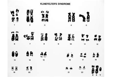 克氏综合症男性最常见的性染色体异常疾病搜狗百科