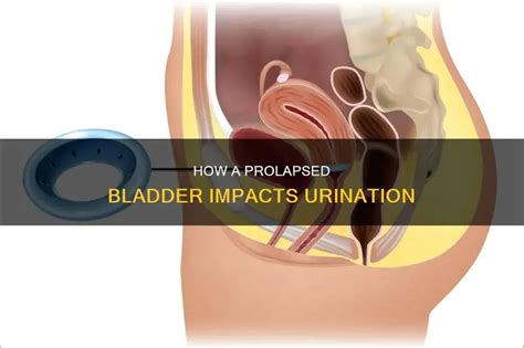 How A Prolapsed Bladder Impacts Urination Medshun