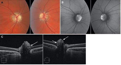 Papilledema A Review Of Etiology Pathophysiology Diagnosis And