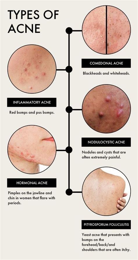 Different Types Of Acne And How To Treat Them Artofit