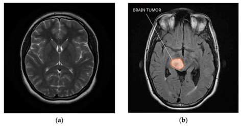 The Vgg16 Method Is A Powerful Tool For Detecting Brain Tumors Using