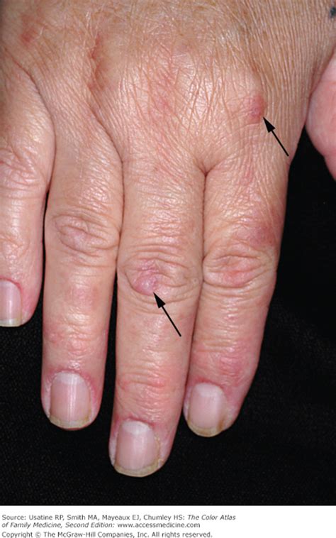 Nodule De Gottron Sur Les Articulations Rtsrcj
