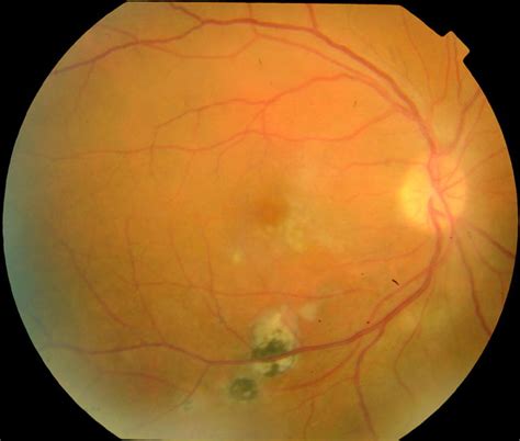 Fundus Photography Discloses Active Punctate Retinitis In The Fovea As Download Scientific