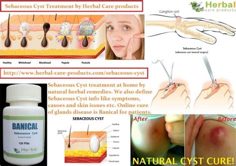 10 Natural Remedies For Sebaceous Cyst Herbal Care Products Blog