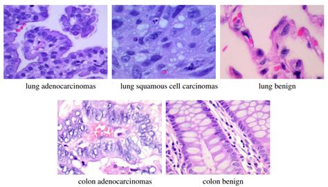 Github Mohamedbashir Diagnosis Lung And Colon Cancer Using Histopathological Images 🔬this