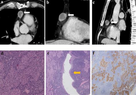 Micronodular Thymoma With Lymphoid Stroma Contrast Enhanced Ct
