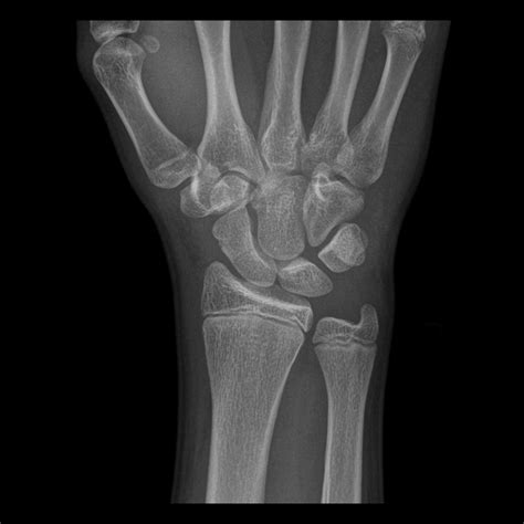 Carpal Bone Fracture