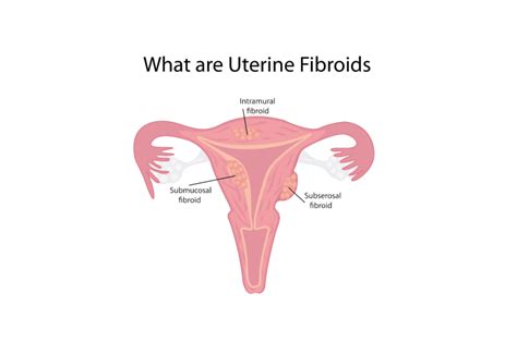 Fibroids Symptoms Cause And Treatment Options Alliance Ob Gyn Obgyns