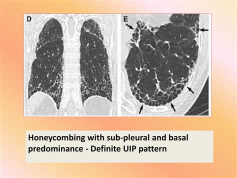 Hrct Basics Of Uip Posterpptx Lung And Respiratory Health Diseases