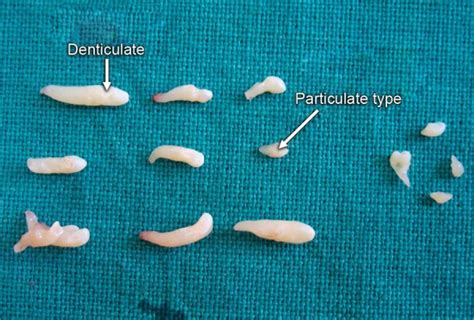 Odontome A Brief Overview Abstract Europe Pmc
