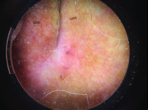 Dermoscopy Of The Primary Skin Lesion Download Scientific Diagram
