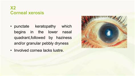 Xerophthalmia Wps Office Pptx