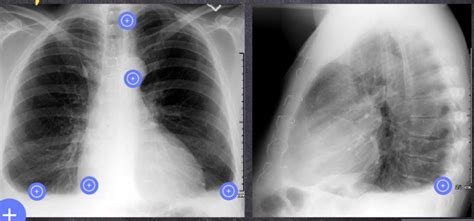 Cxr Case 3 Diagram Quizlet