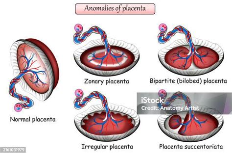 Anomalies Of Placenta Stock Illustration Download Image Now