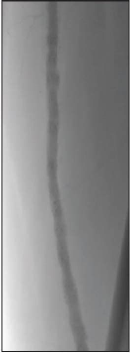 Optimized Pta With Tack Salvage Following Rendezvous Subintimal Sfa Cto